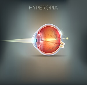 Ophthalmologist Jackson | Hyperopia Flowood | Mississippi Vision